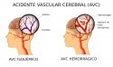 Acidente Vascular Cerebral (AVC) - tipos, causas, sintomas - InfoEscola