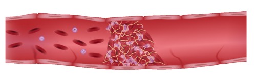Embolia - Embolismo - Sistema Circulatório - InfoEscola