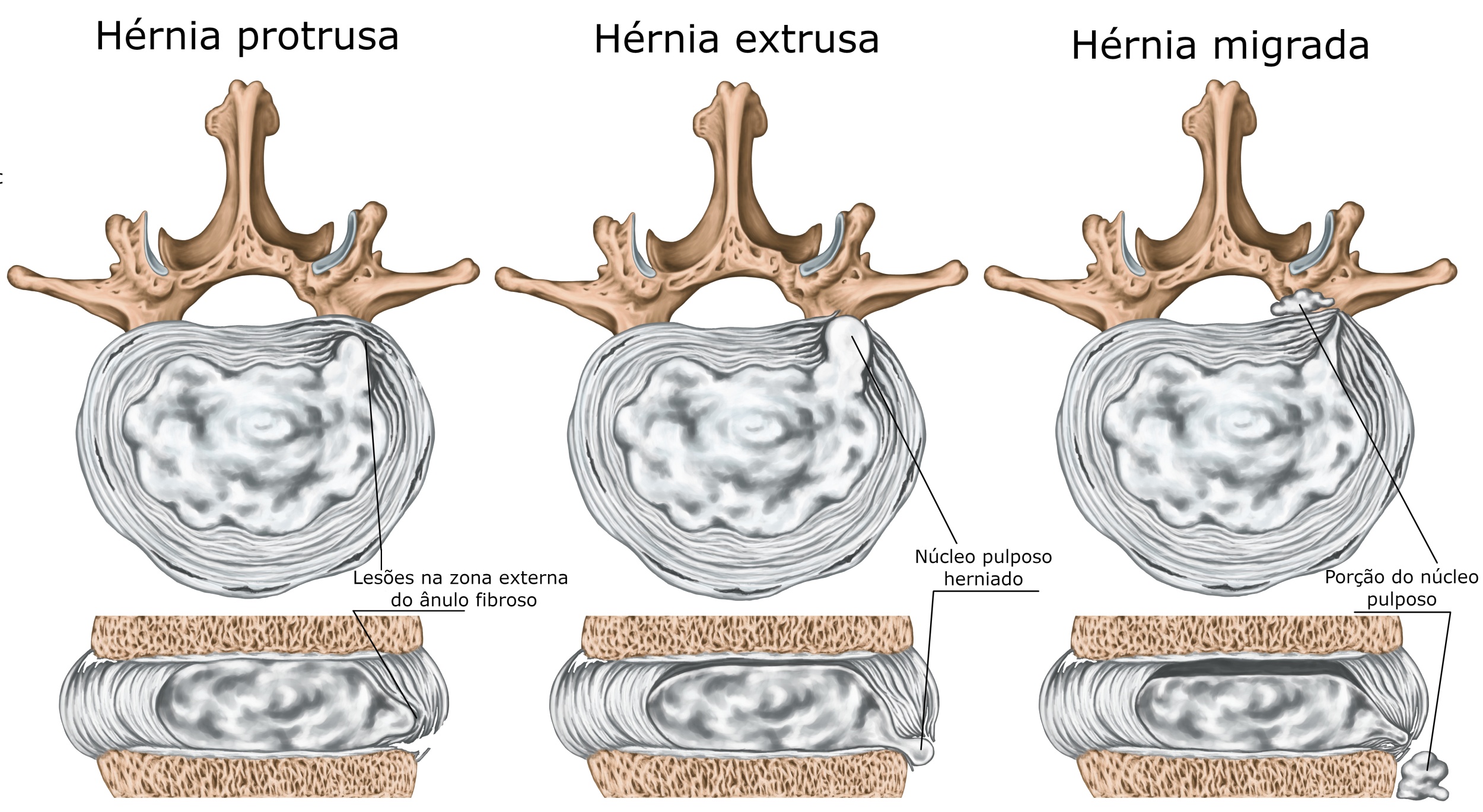 Hérnia de disco - tipos, causas, sintomas, tratamentos - Ortopedia ... Hérnia de disco - tipos, causas, sintomas, tratamentos - Ortopedia ...