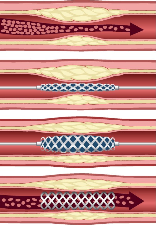 Stent cardíaco - Cardiologia e Medicina - InfoEscola