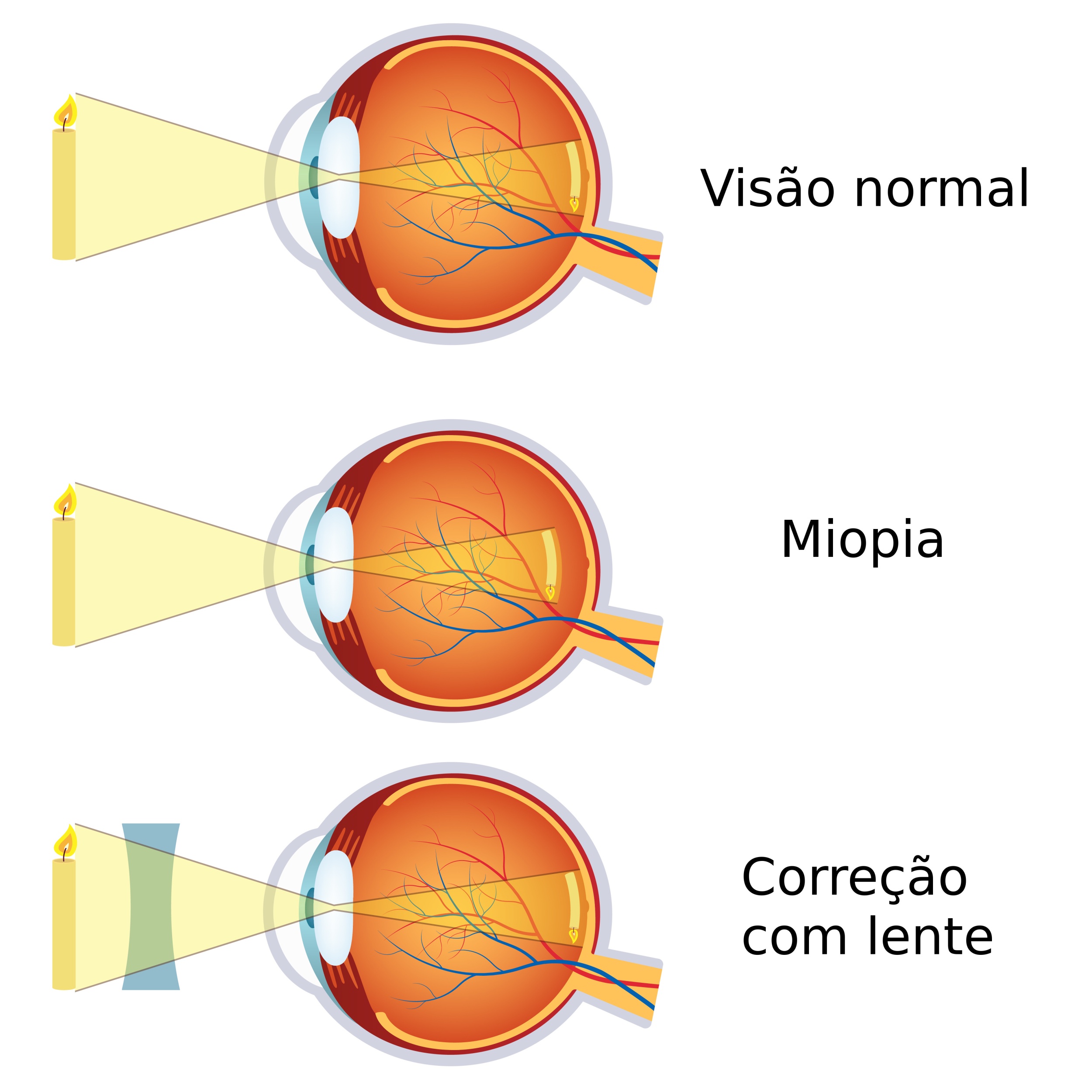 Miopia Vis o InfoEscola